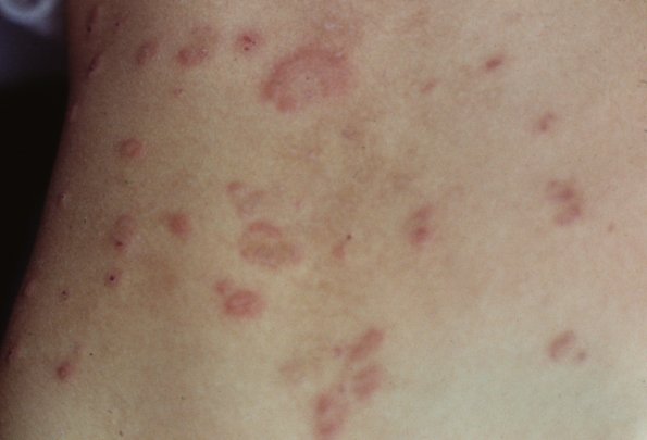 PICT0002 | Wells Syndrome | Dr. Ken Hashimoto | Wayne State University SOM - Dermatology Image ...